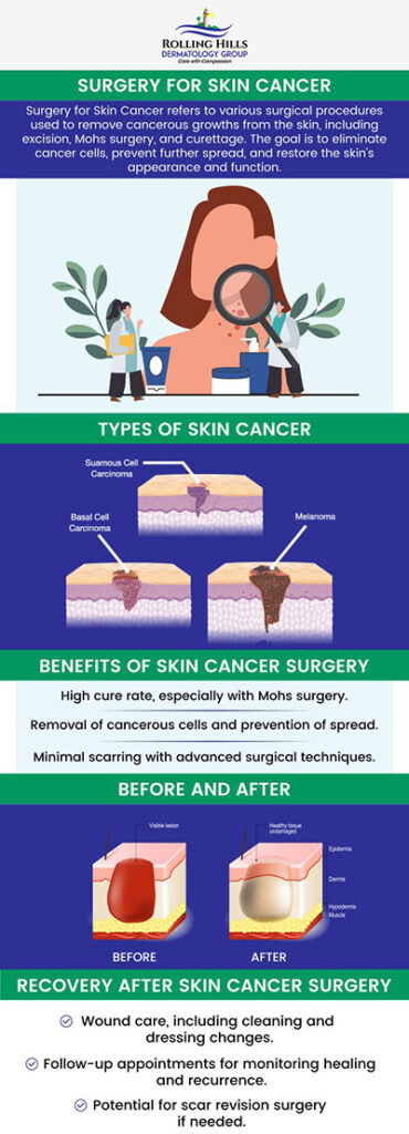 Skin Cancer Surgery Specialist in Rolling Hills Estates, CA